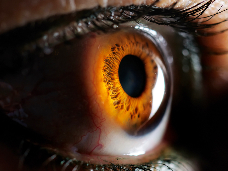 Greffe cornée artificielle Tunisie : kératoprothèse - prothese oculaire ...